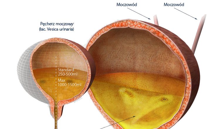Bejsment - Zapalenie pęcherza moczowego